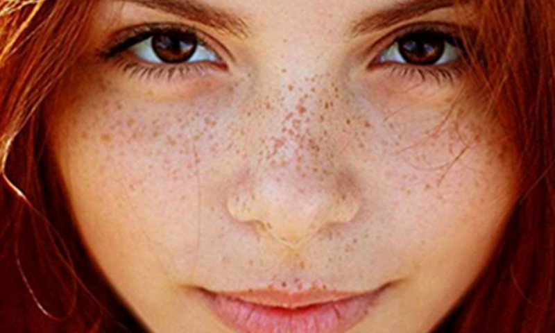 Las pecas no suelen ser señal de un trastorno oculto de la piel ...